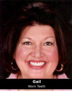 Worn Teeth Gallery | Teeth Transformations by Amy Norman, DDS