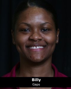 Eliminating Gaps Gallery | Teeth Transformations | Amy Norman DDS