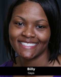 Eliminating Gaps Gallery | Teeth Transformations | Amy Norman DDS